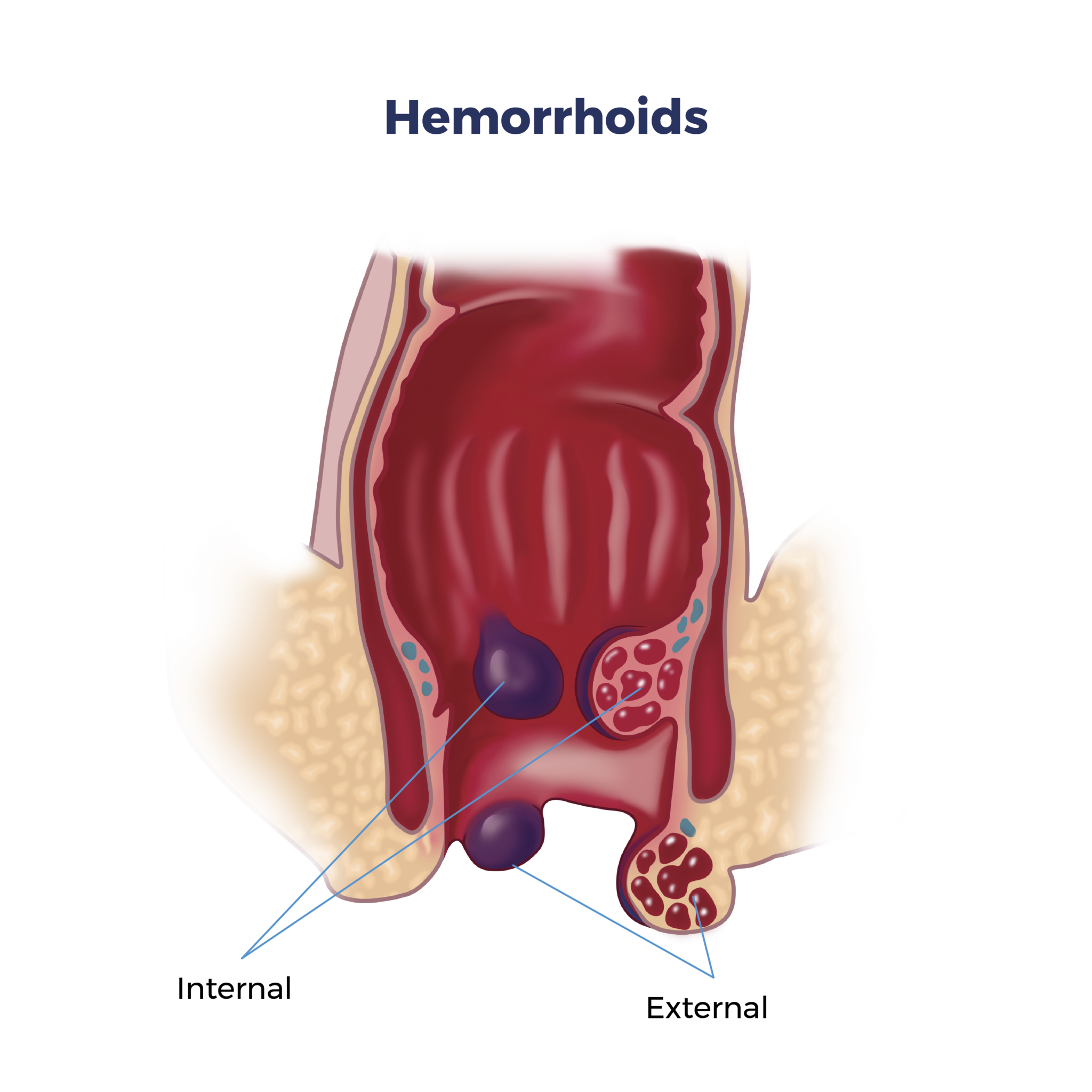 Beyond the Scalpel: A Minimally Invasive Approach to Hemorrhoid Relief ...