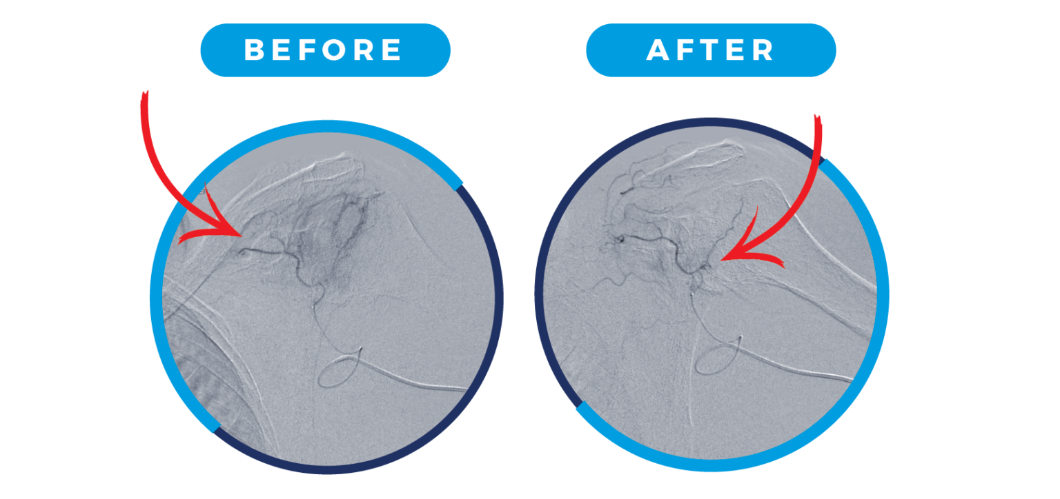 Shoulder Embolization – arvcenters