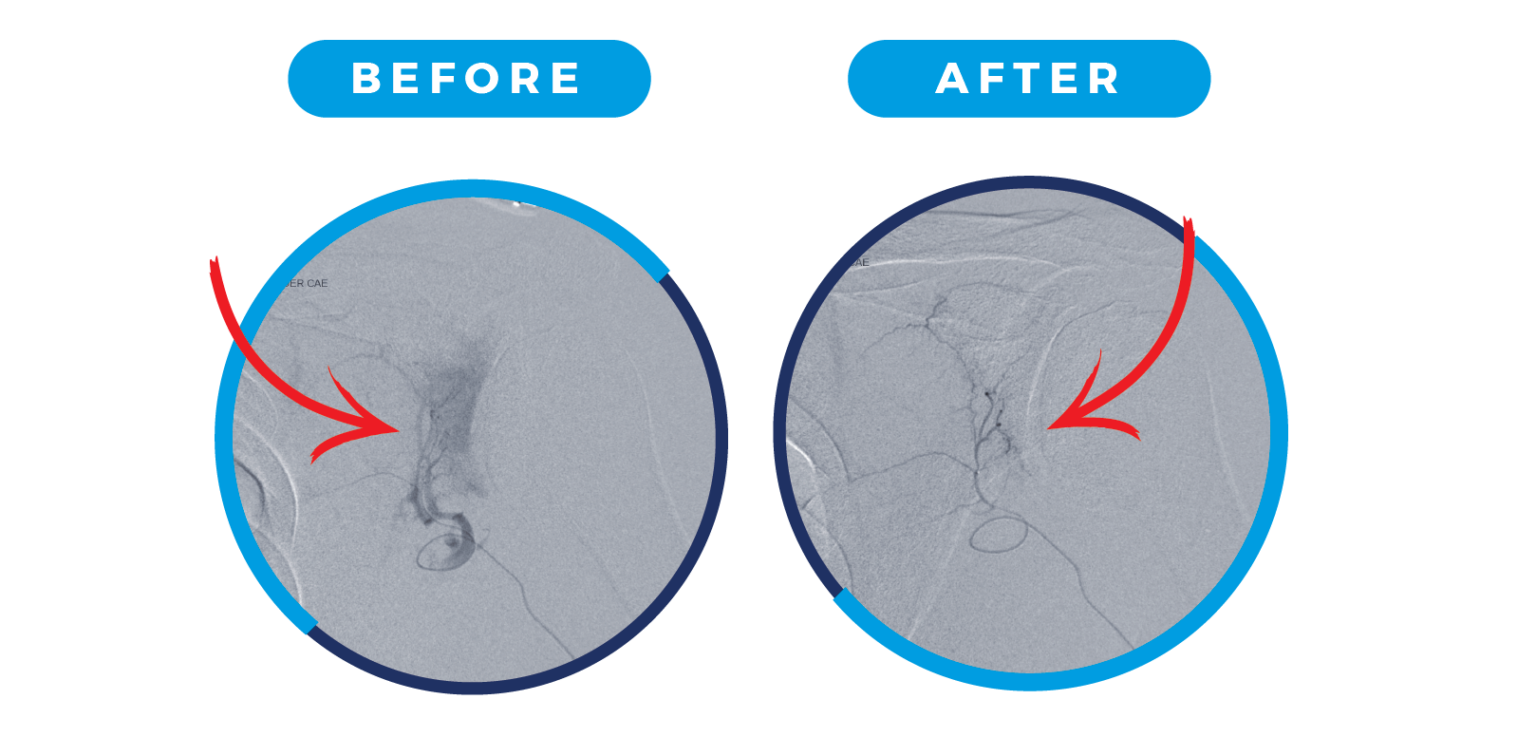 Shoulder Embolization – arvcenters