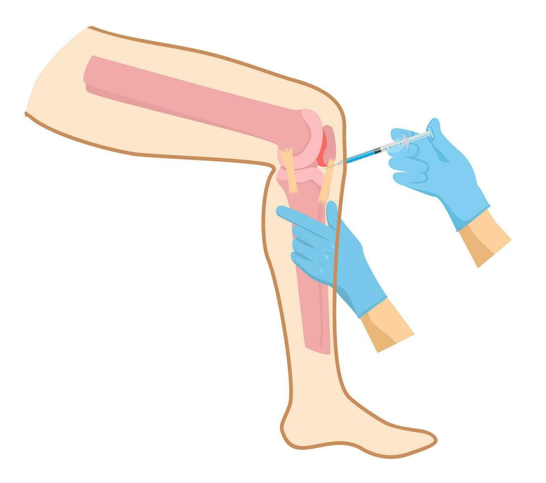 Seeing is Believing: Why Precision-Guided Joint Injections Make a ...
